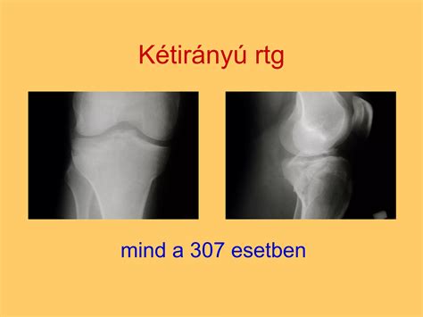 Role Of Ct In The Diagnostics Of Proximal Intraarticular Tibia Fractures Power Point Ppt
