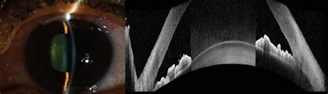 Eye News On Linkedin Aqueous Misdirection A Case Series Of Unexpected Surgical Complications