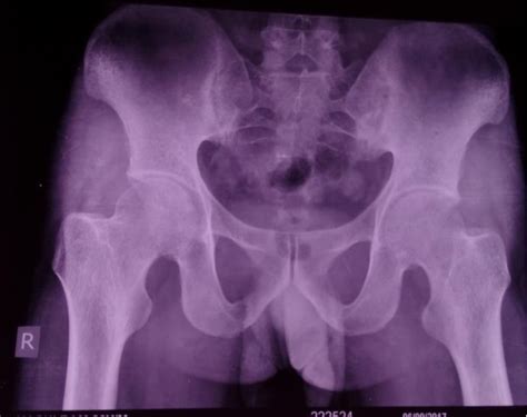 Bilateral Sacroiliitis A Rare Cause For A Common Presentation