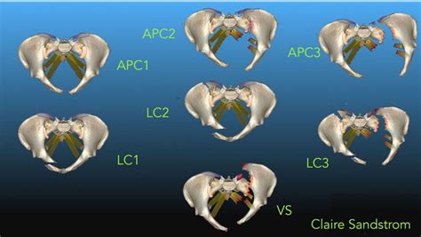 Young Burgess Classification Of Pelvic Fractures Uw Emergency Radiology