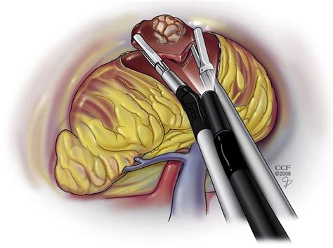 Single Port Laparoscopic And Robotic Partial Nephrectomy European Urology