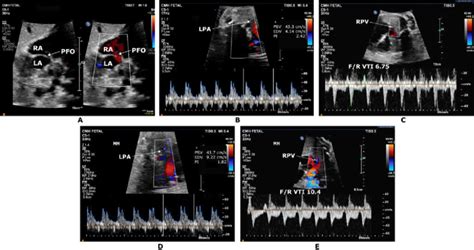 Maternal Hyperoxygenation Mh Testing In A Third Trimester Fetus With Download Scientific