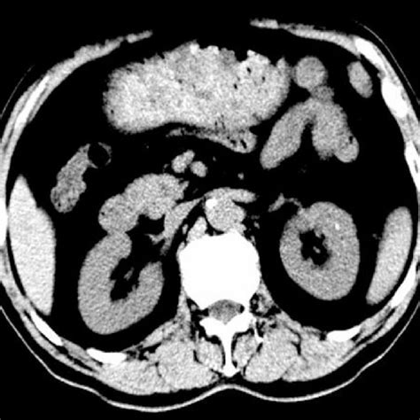 E Pyelography Demonstrates The Right Pyelosinus Backflow White Arrow
