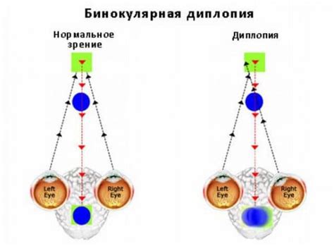 Двоится в глазах причины двоения почему раздвоение в одном лечение