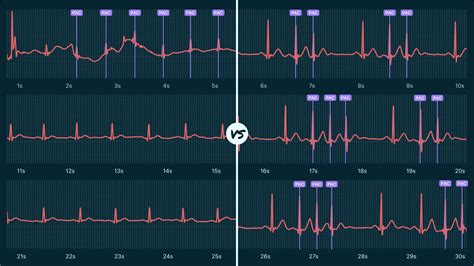 Ectopic Atrial Rhythm Vs Supraventricular Tachycardia Non Sustained