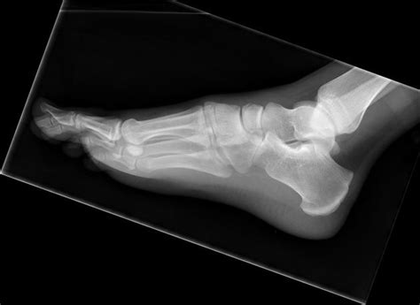 Navicular Fracture Radiology Reference Article Radiology Fracture