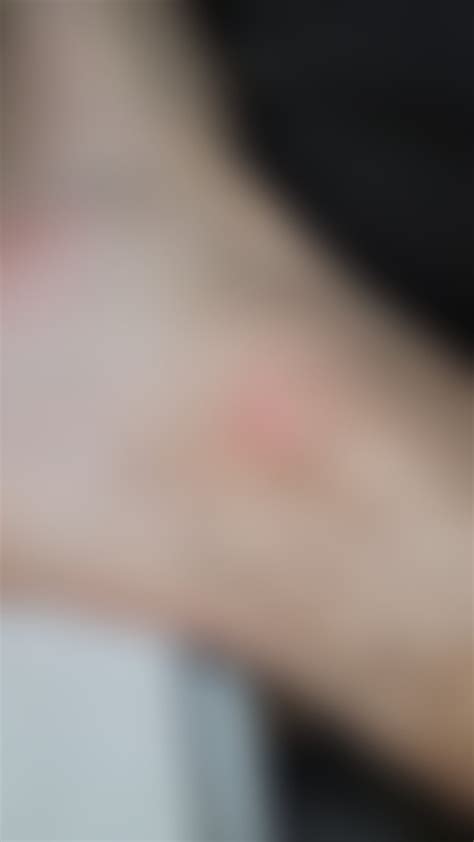 Ankle Rash Id Dermatology