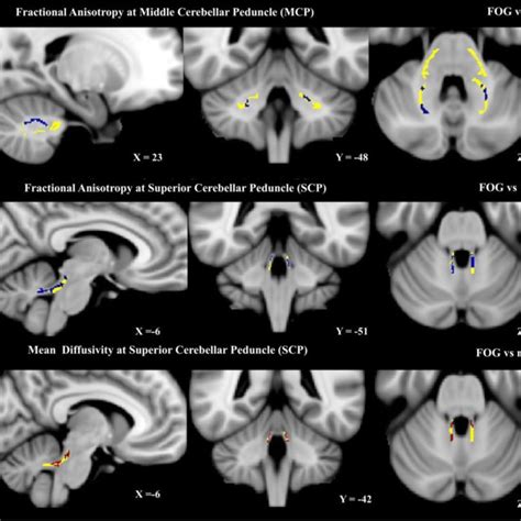 Rsfc Differences Between Subgroups Of Pd Patients And Healthy Subjects