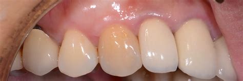 牙肉重建案例分享 Dr Implant 新竹光明牙醫診所