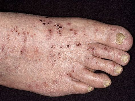 Shingles On Ankle