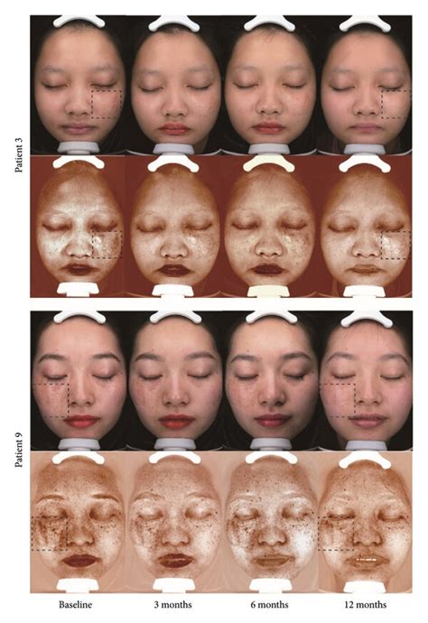 A Treatment Flow Chart B Schematic Diagram Of Injection Position Download Scientific