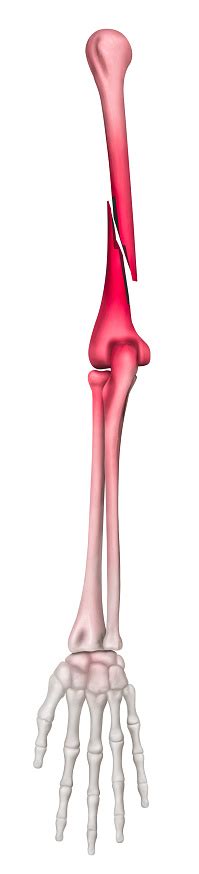 상 완 골 골절 또는 깨진 팔 통증 영역 완료에 빨간 하이라이트 난민 골절 유형 앞쪽 보기3d 의료 및 생물 의학 그림인간 해부학 의료 개념흰색 배경 X 레이에 대한 스톡