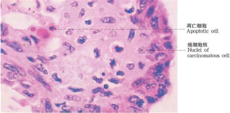56 癌细胞凋亡 病理学图谱