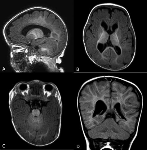 A Novel Pathogenic Variant In The Mn1 Gene In A Patient Presenting With Rhombencephalosynapsis