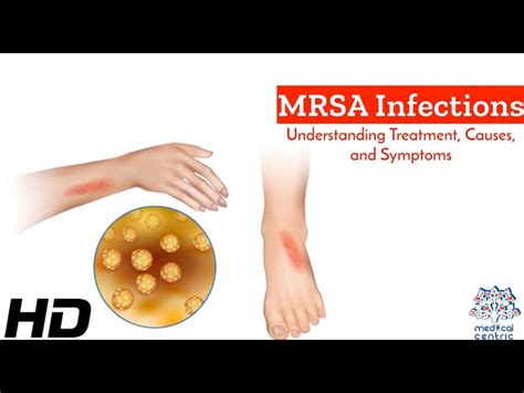 Mrsa Symptoms Impetigo Practice Essentials Background