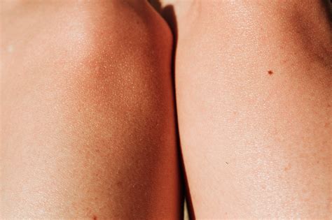 Sebaceous Cyst On Inner Thigh