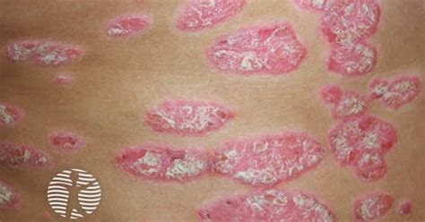 Chronic Plaque Psoriasis Image
