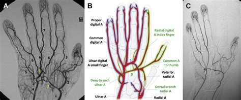 Interpretation Of Upper Extremity Arteriography Hand Clinics