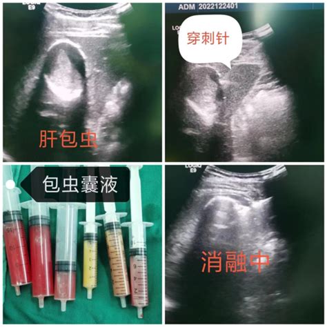 介入之手——超声引导下子宫肌瘤射频消融术、甲状腺结节消融术、肝包虫射频消融术 卫健新闻 巴彦淖尔市卫生健康委员会