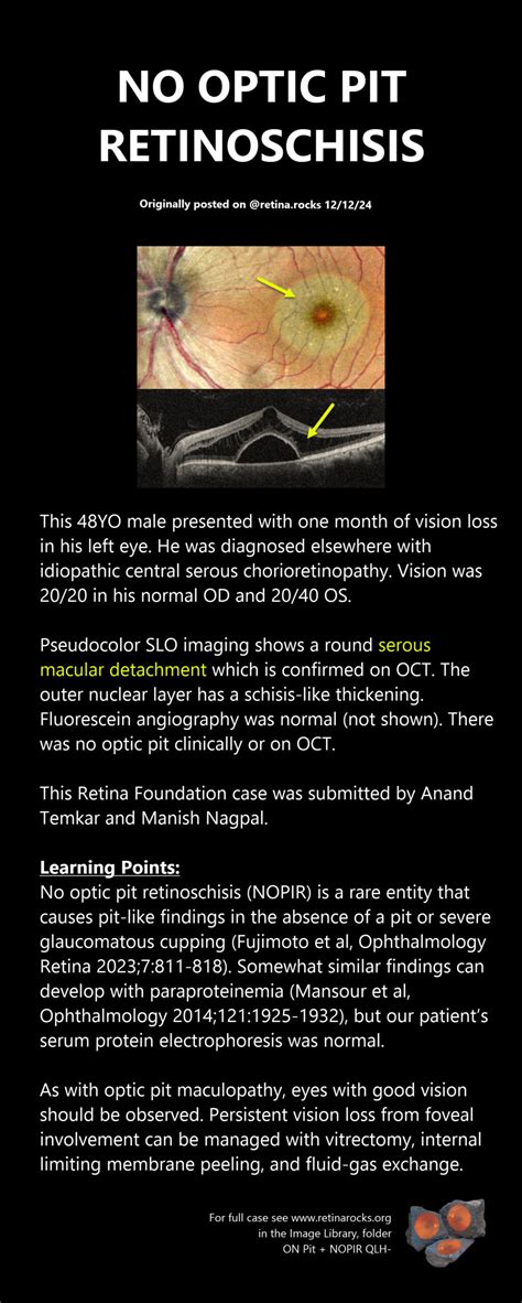 Optic Nerve Disorders Optic Nerve Pit And No Pit Retinoschisis