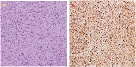 A Histopathology Image Showing Abundant Myxoid Stroma With Nuclear Download Scientific