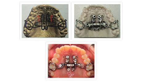 Custom Miniscrew Assisted Rapid Palatal Expansion Marpe Smile Design