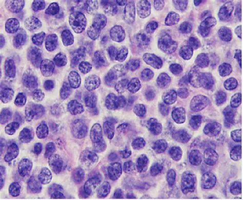 Cytology Image Shows Small Cells With Hyperchromatic And Cleaved