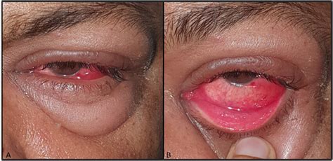 A Case Of Severe Acute Viral Conjunctivitis With Lid Swelling