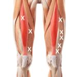 Quad Trigger Points How To Find And Treat