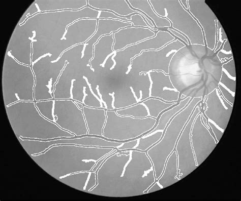 Figure 1 From Retinal Vessel Tree Segmentation Using A Deformable