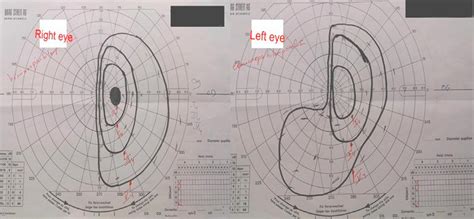 Goldmann Visual Field Perimetry Showing Bitemporal Hemianopsia