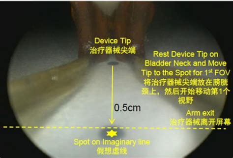 超微创时代！泌尿外科成功开展前列腺热蒸汽消融术 新闻中心