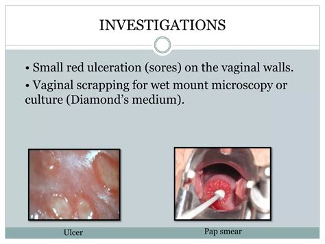 Trichomoniasis Pptx