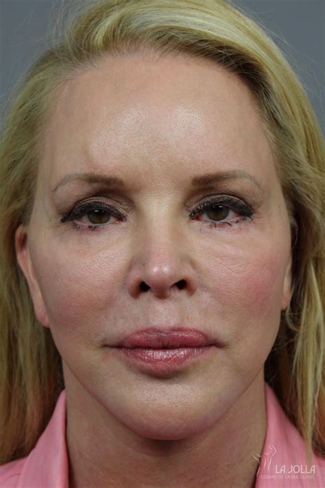 Liquid Facelift Before After Gallery