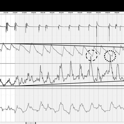 The Respiratory Parameters AHI Apnea Hypopnea Index Apnea Hypopnea Download Scientific