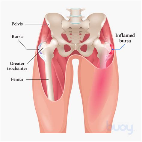 Sensational Info About How To Diagnose Hip Bursitis Tonepop