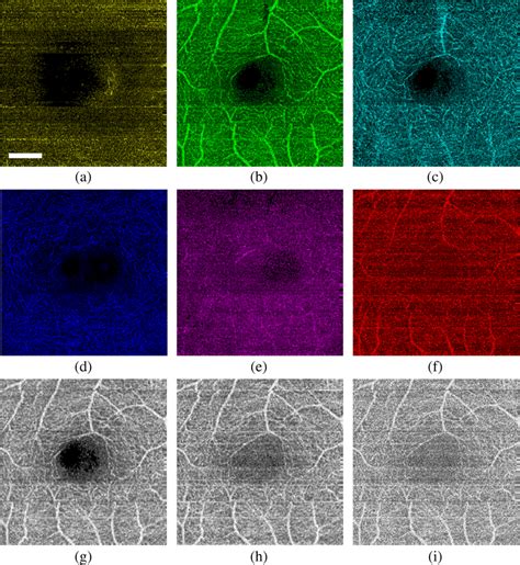Intensity Based Doppler Variance Method Combined With 3 D Segmentation