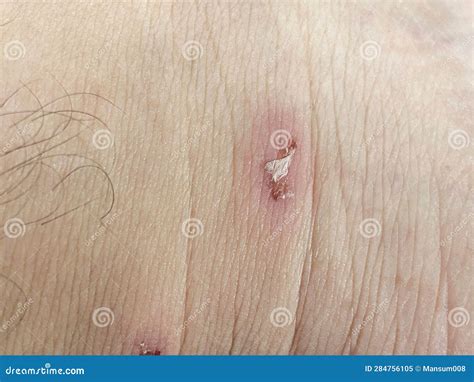Scar On Human Body Stock Image Image Of Disease Brown 284756105