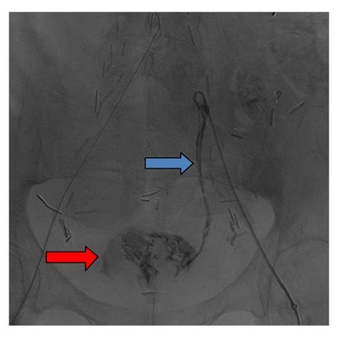 Left Ureteral Retrograde Pyelogram Demonstrates Contrast Opacification Download High