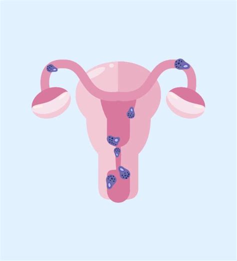 Clamidia Positiva Síntomas Causas Y Diagnóstico