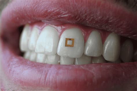 Tooth Mounted Sensor Can Track What You Eat
