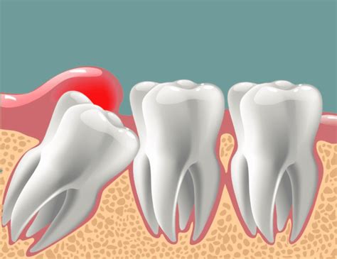White Gums After Tooth Extraction