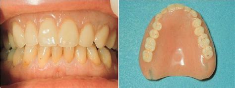 Dentistry Lectures For Mfds Mjdf Nbde Ore A Note On Immediate Dentures
