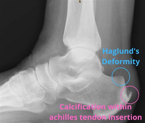 Case Discussion Severe Insertional Achilles Tendinopathy And Large
