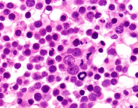 Spermatocytic Seminoma Typical Histologic Features Case Four Of