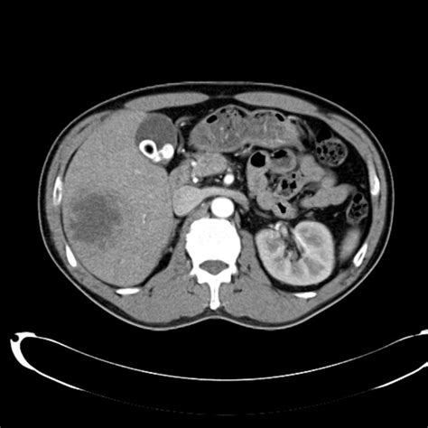 Differential Diagnosis Of Hepatic Abscess