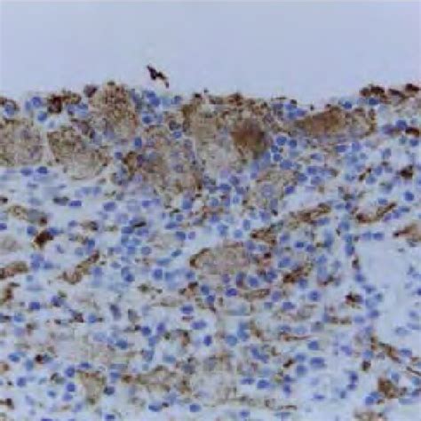 Biopsy Of Greater Omentum 10x40 Infiltration Of Giant Multinucleated