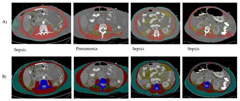 Concordance Of Computed Tomography Regional Body Composition Analysis