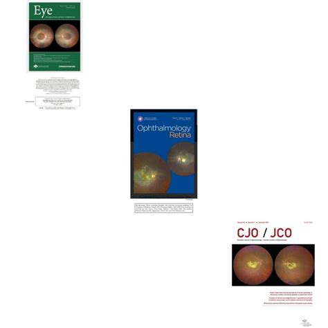 T P Vignesh On Linkedin Three Cover Images In The Top International Ophthalmology Journals So Far…