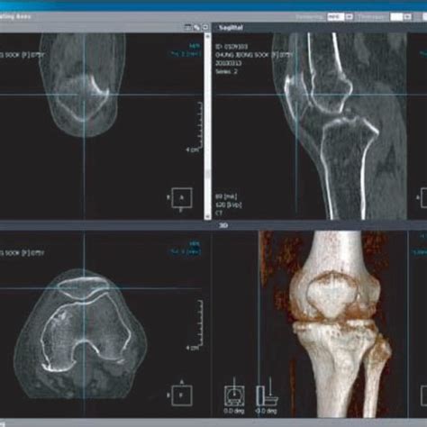 Pdf Three Dimensional Ct Based Virtual Patellar Resection In Female